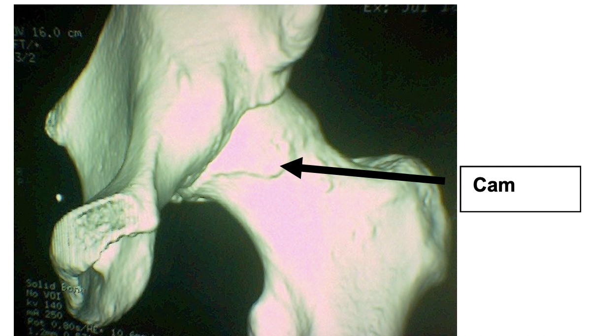 Hip Arthroscopy | Orthosports NZ